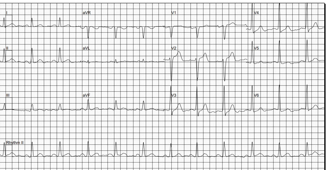 Electrocardiogram: What to Know about the Test - Heart Care for Adults ...