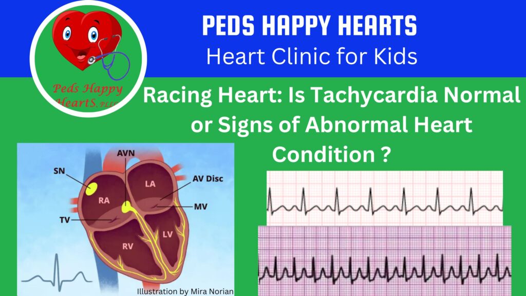 Tachycardia: Causes, Symptoms, and Treatment - Heart Care for Adults ...